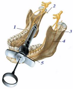 Mandibular anesthesia and torusal anesthesia + video