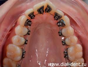 WIN braces – advantages, disadvantages, treatment features on Startsmile.ru