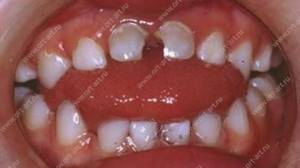 Protruding teeth, tooth protrusion - treatment at the Orto-Artel clinic