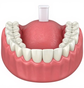 Mandibular anesthesia and torusal anesthesia + video