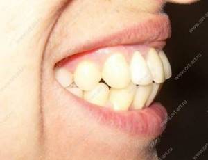 Protruding teeth, tooth protrusion - treatment at the Orto-Artel clinic