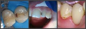 Hidden caries - carious cavities of the tooth on the side