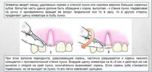 Щипцы для удаления зубов: виды инструментов для нижней и верхней ...