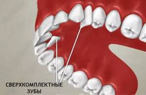 Supernumerary teeth: causes, removal, treatment